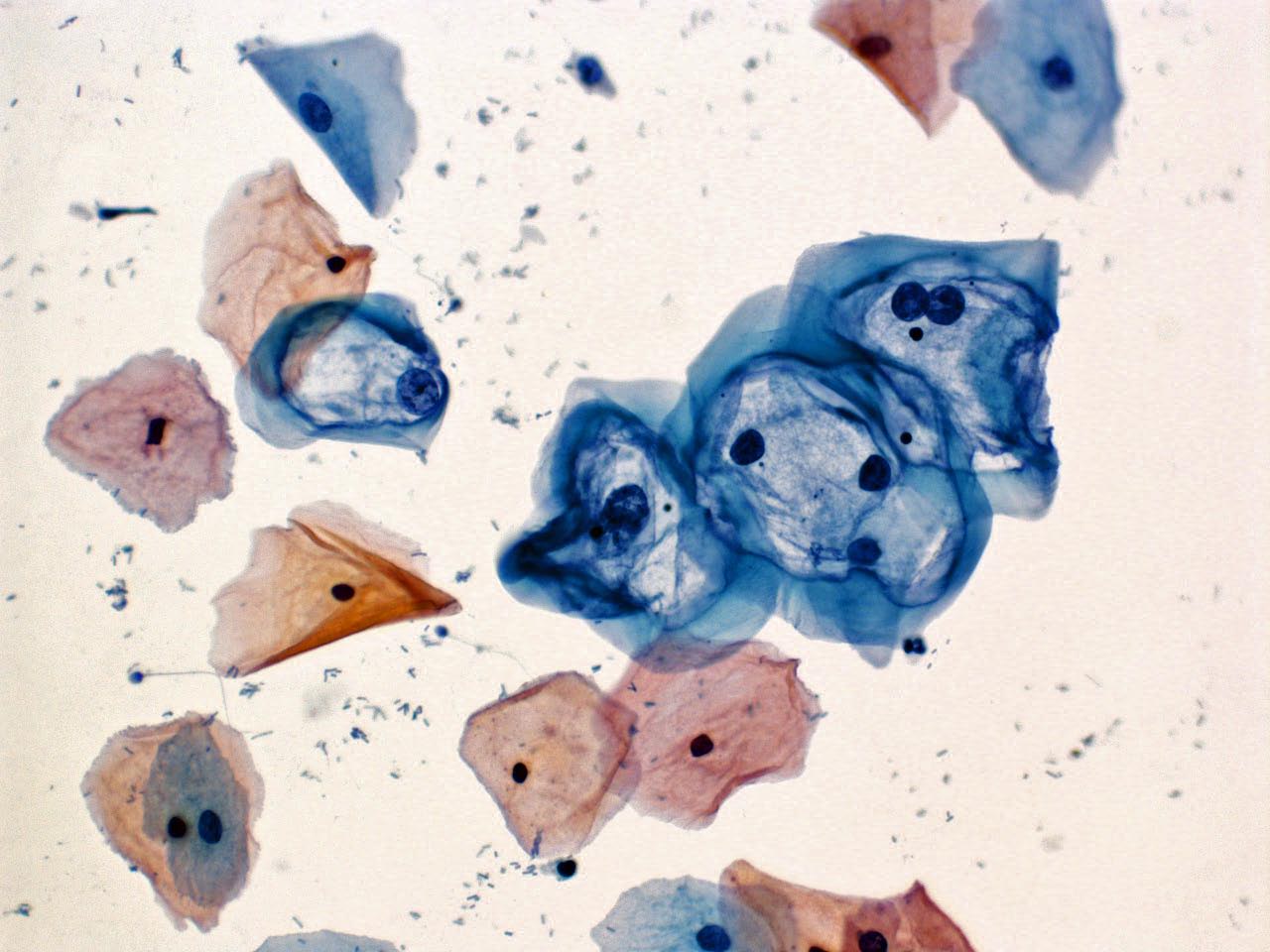 Przebieg infekcji HPV - Cyto HPV test - zdążyć przed rakiem